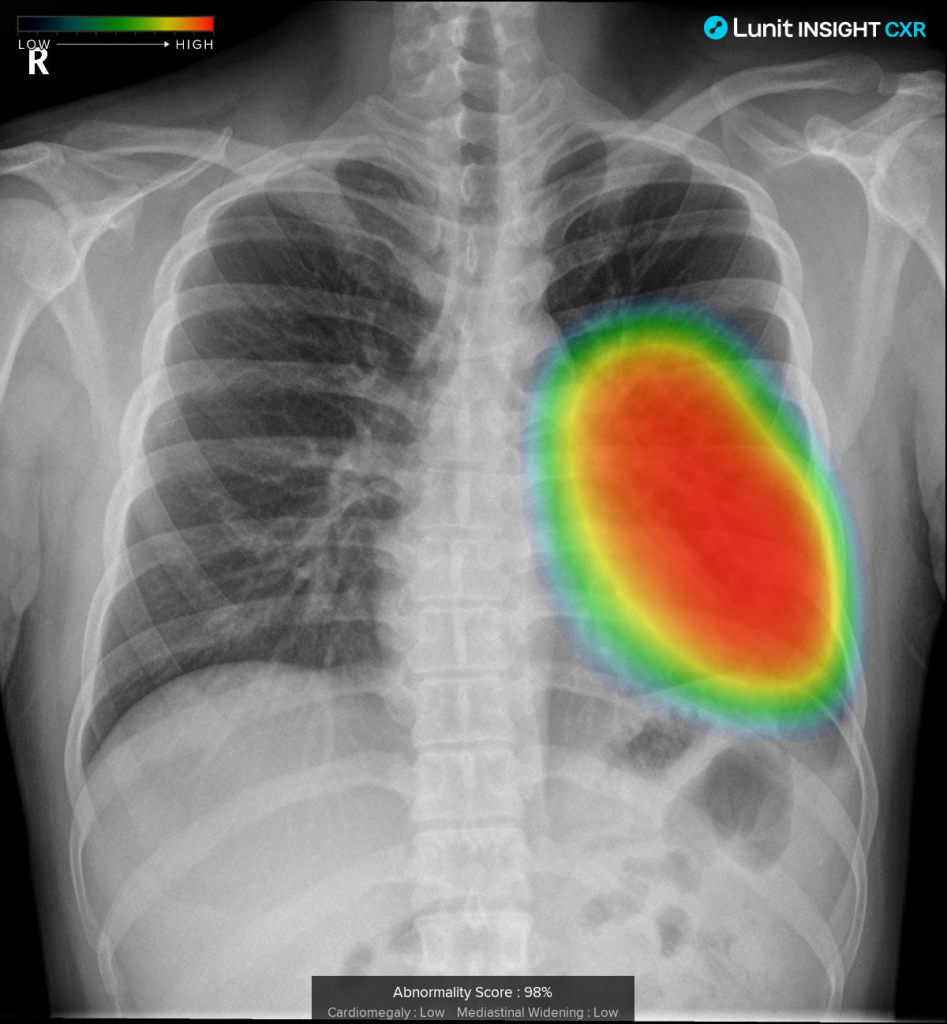 Lunit Insight CXR – Harar