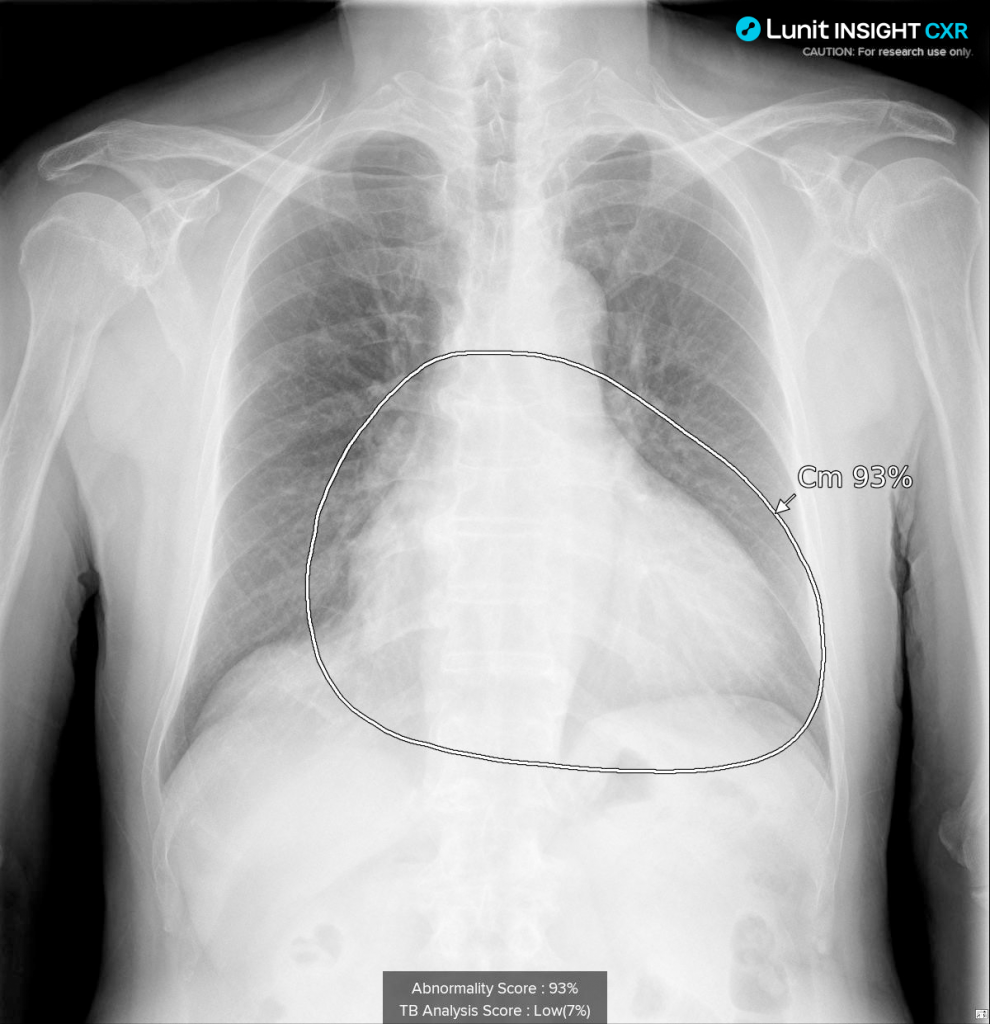 Lunit Insight CXR – Harar